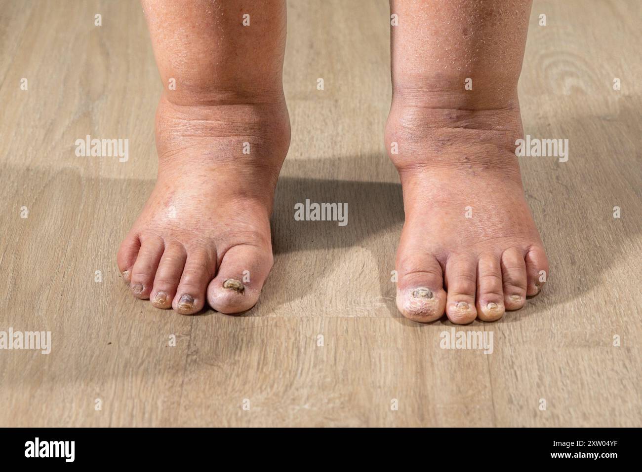 Ankle oedema hi-res stock photography and images - Alamy
