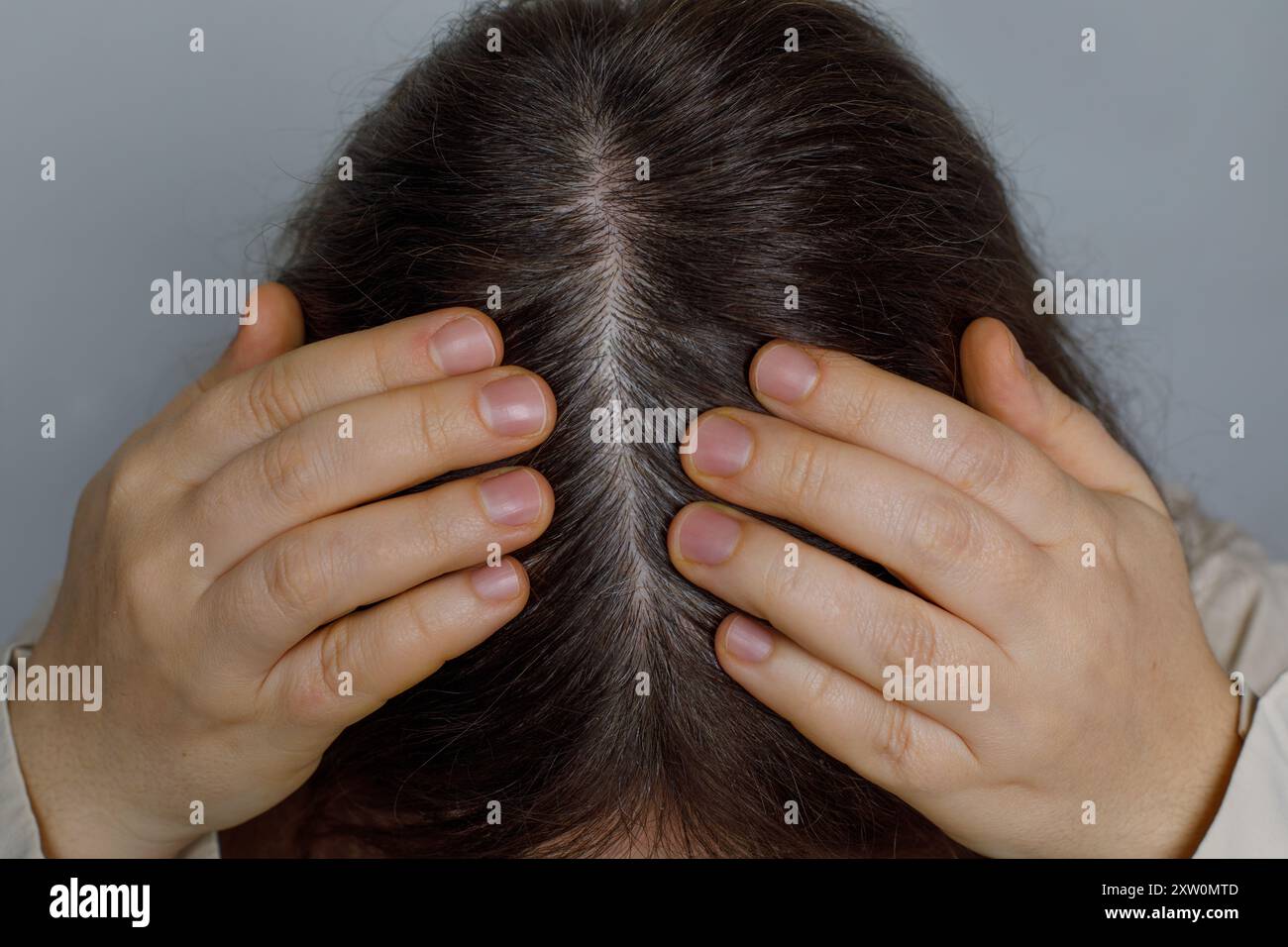 Close up human hair dandruff hi-res stock photography and images - Alamy