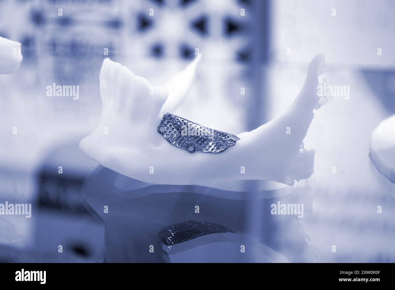 Prototype of lower human jaw with medical titanium implant from ...