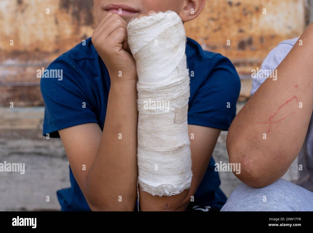 Childhood Memories: Two Young Boys, a Broken Arm in Cast, and Scratches ...