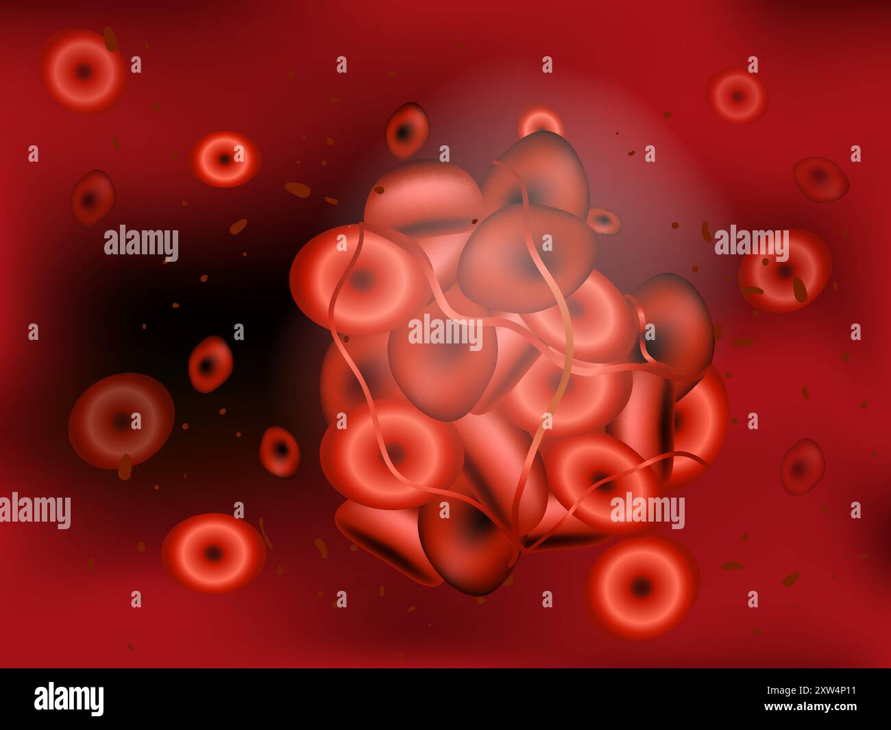 Deep vein thrombosis illustration Stock Vector Images - Alamy
