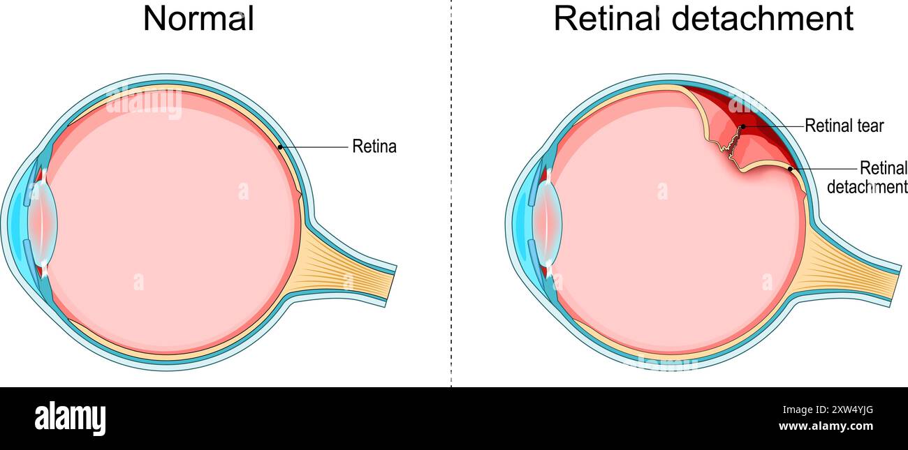 Retinal detachment. Cross section of a normal human eyes and disorder ...