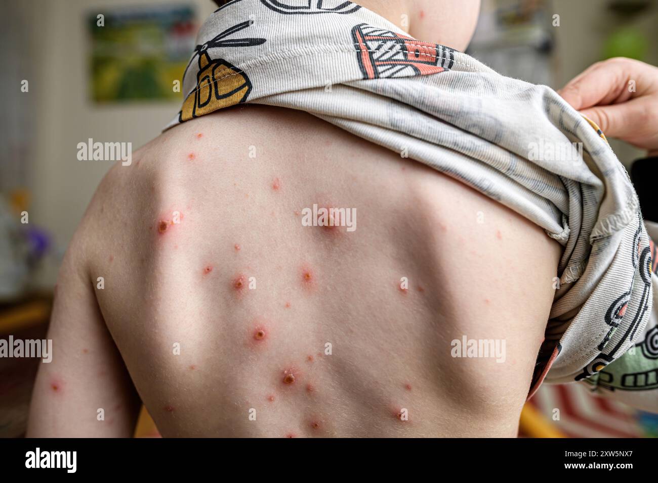 A close-up view of a child's back covered with red, inflamed chickenpox ...