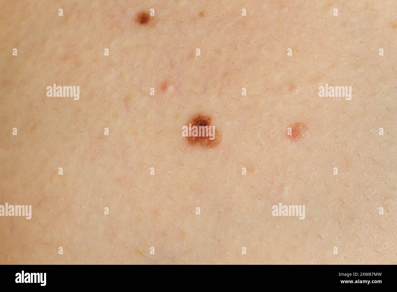 Birthmark woman hi-res stock photography and images - Alamy