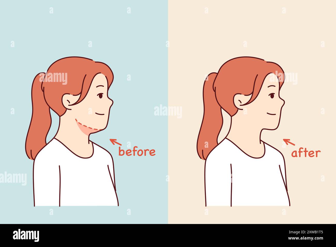 Double chin removal surgery for young girl posing before and after ...