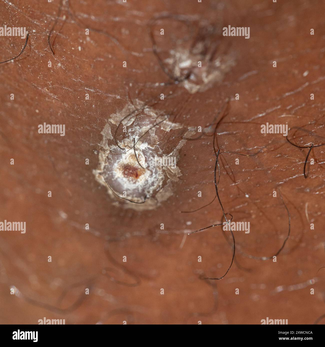 Macro photograph showing the details of the molluscum contagiosum virus ...