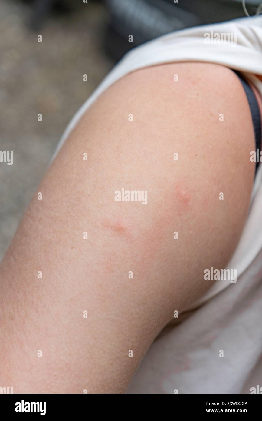 Mosquito bites on schoulder of Blonde Girl. Girl with Mosquito bites on ...