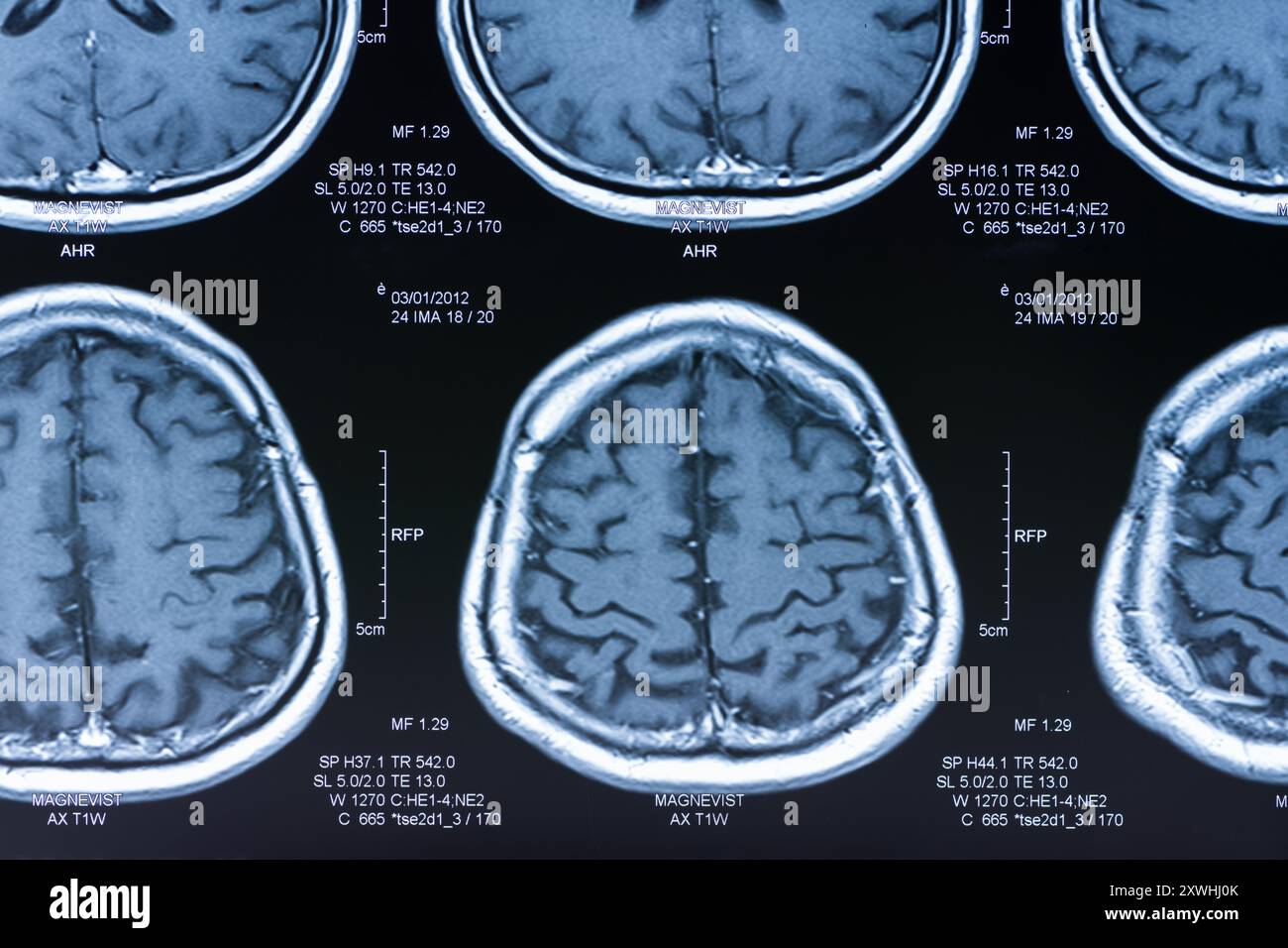 image of brain scan patient by ct scan Stock Photo - Alamy