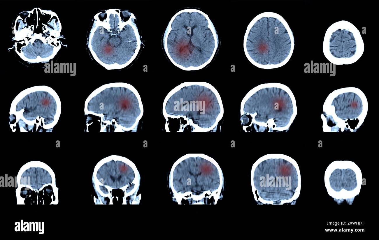 MRI scan brain, ct scan of brain sagittal, coronal, transverse image ...