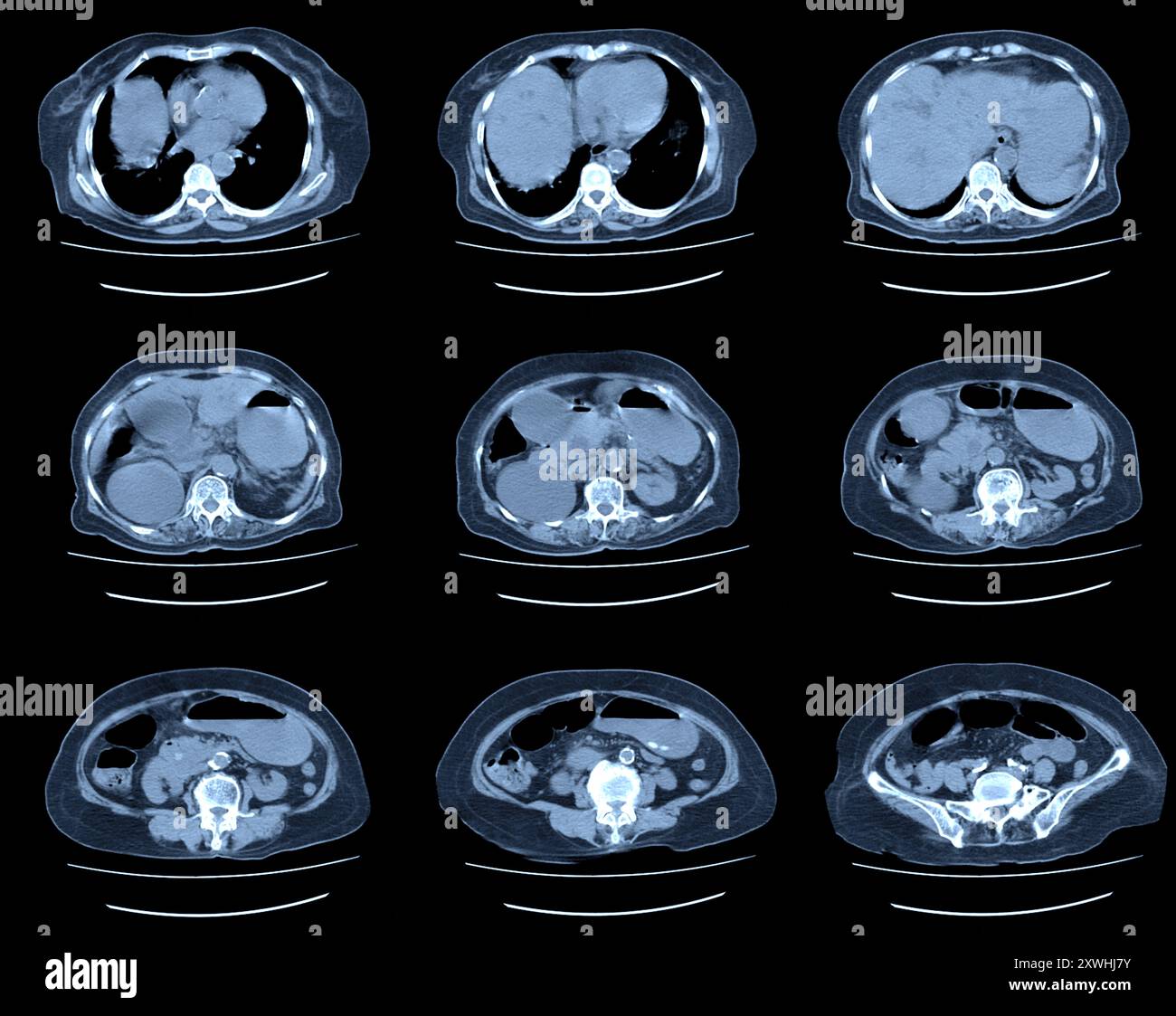Ct scan abdomen hi-res stock photography and images - Alamy Ct scan abdomen hi-res stock photography and images - Alamy