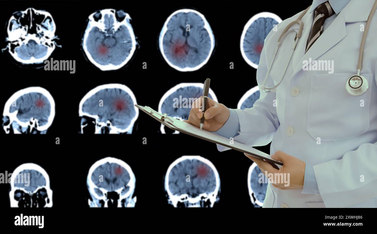 Doctor diagnosis image mri scan brain, ct scan of brain intracerebral hemorrhage, tumor Stock ...