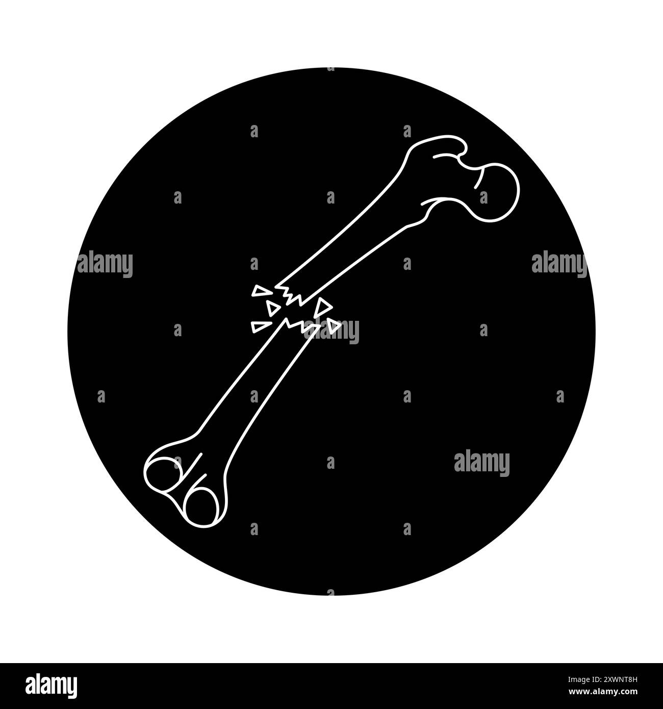 Oblique fracture hi-res stock photography and images - Alamy