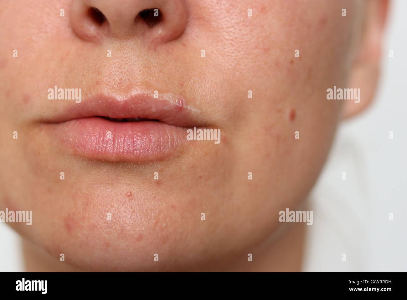 Herpes concept close up hi-res stock photography and images - Alamy