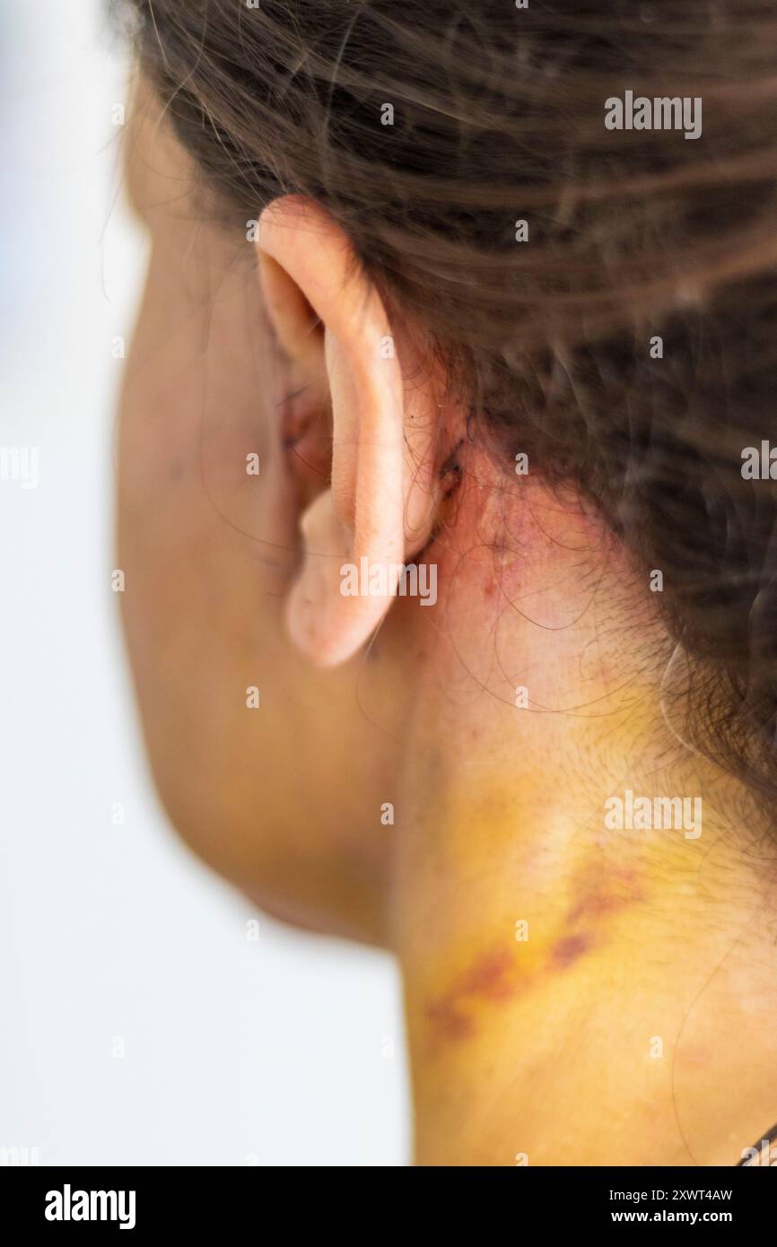 Shot of the stitches and scars on woman head after cosmetic surgery ...