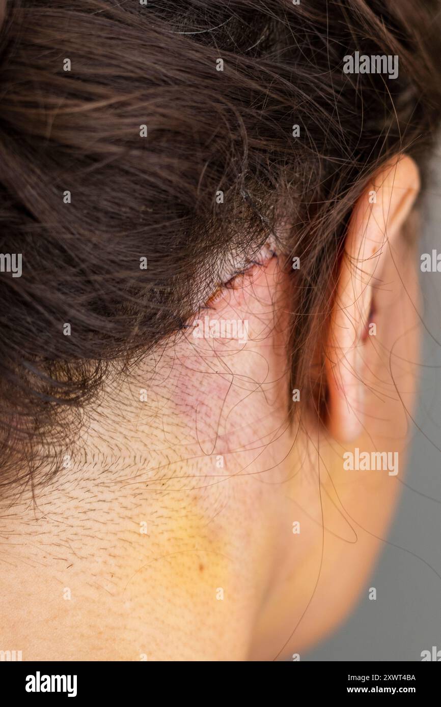 Woman injury head stitches hi-res stock photography and images - Alamy