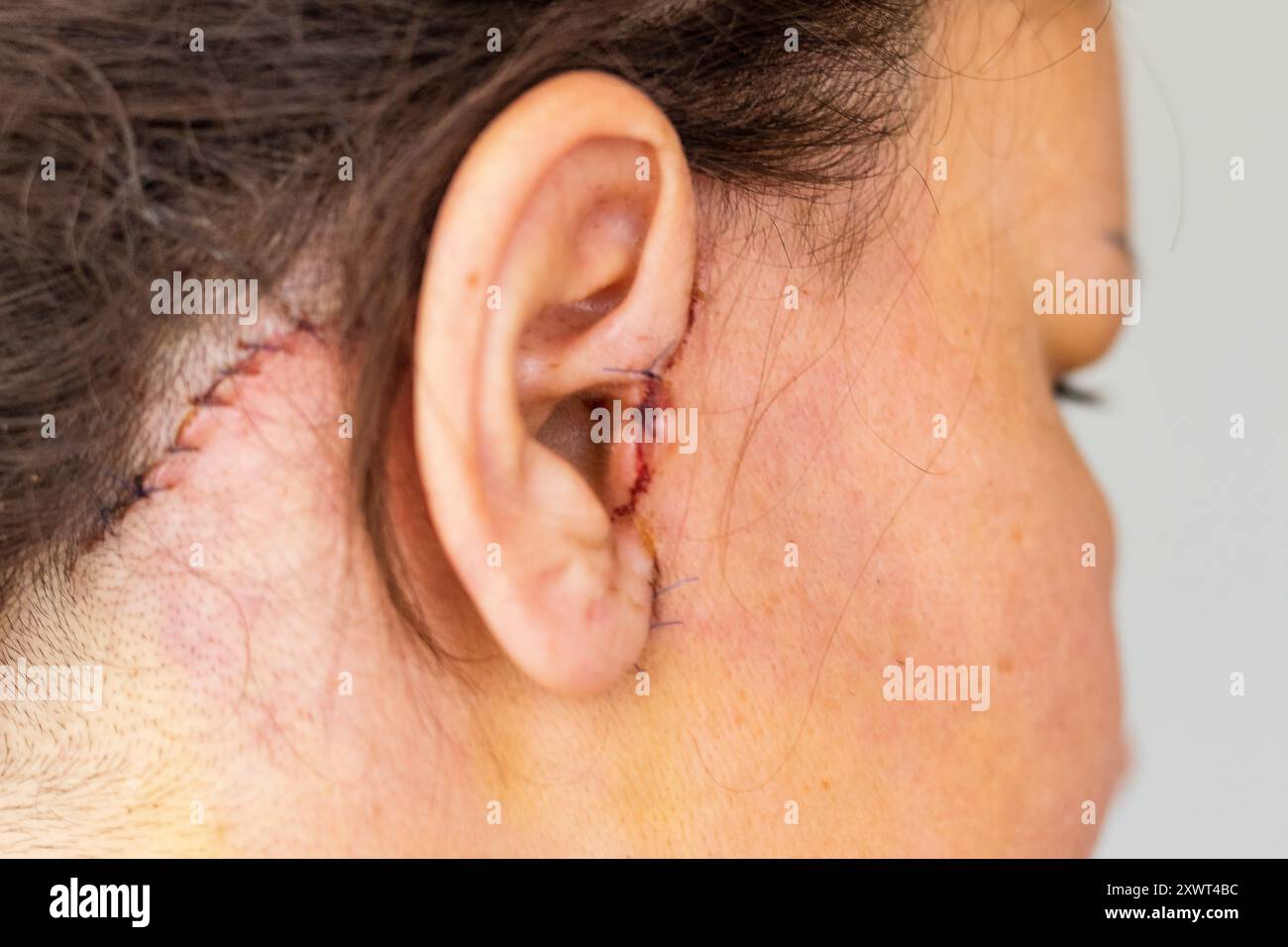 Shot of the stitches and scars on woman head after cosmetic surgery ...