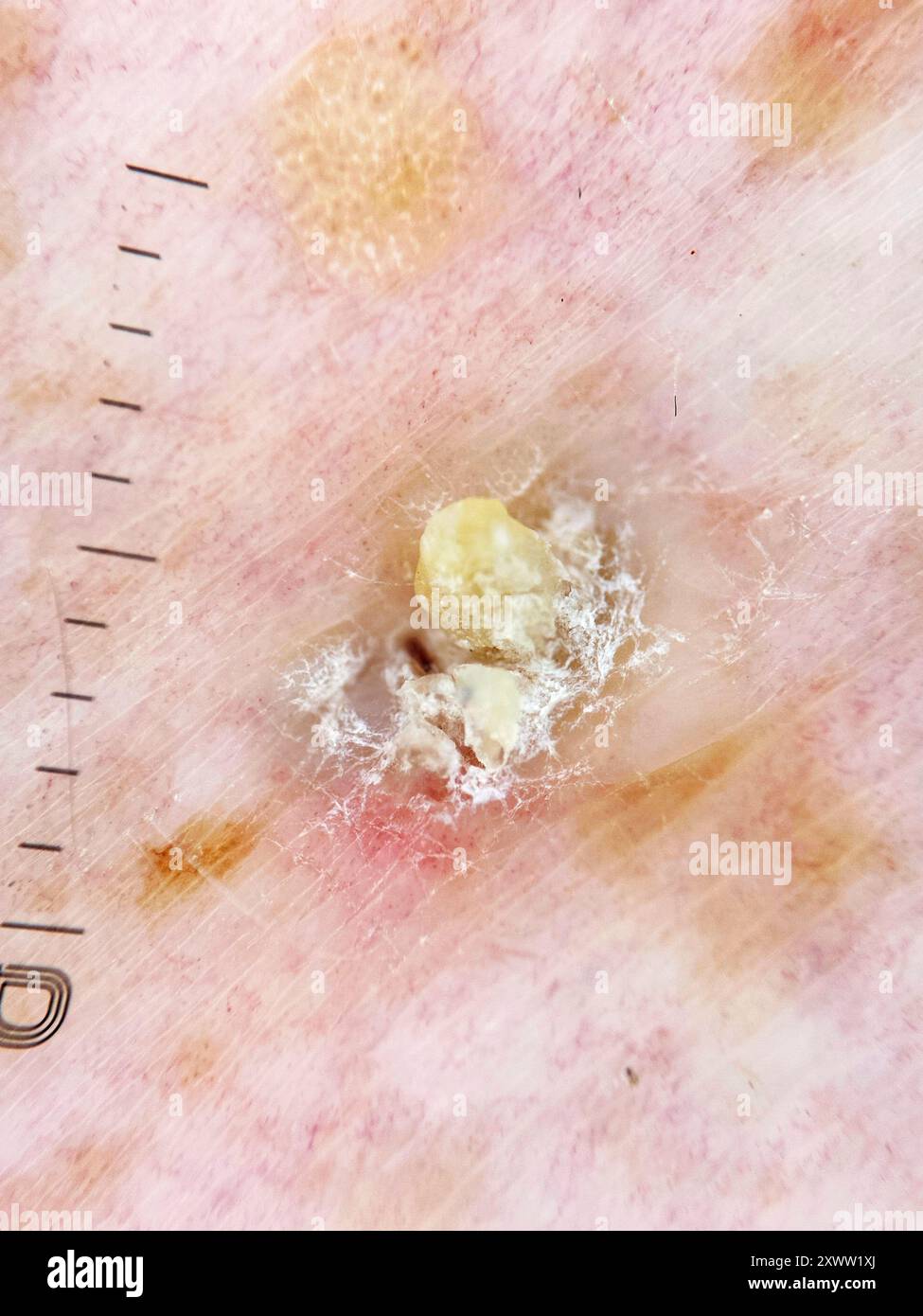 Dermatoscope image of a lesion on the leg of a white female patient ...