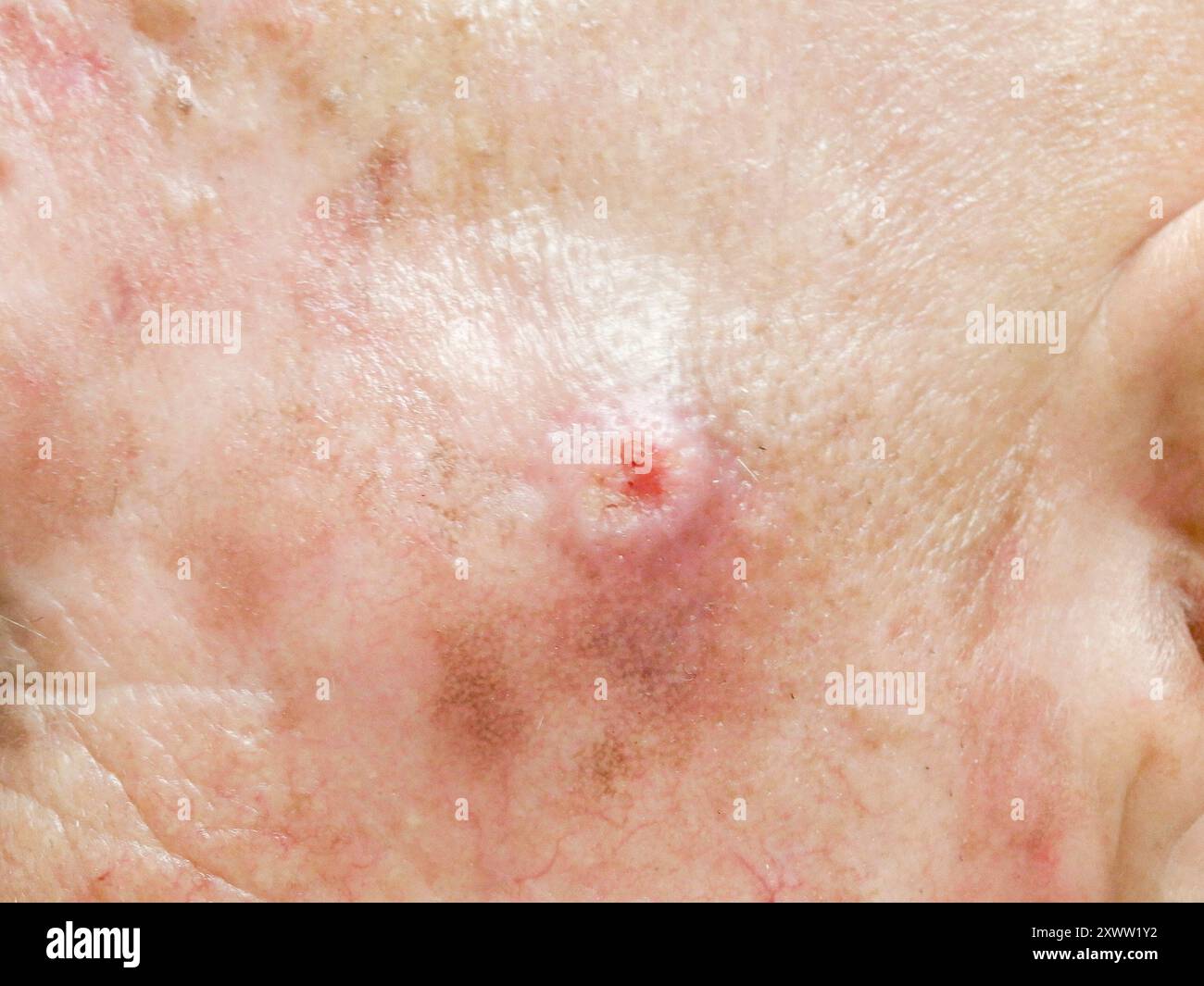 Lesion on the temple of a Hispanic male patient with Bowen's disease ...