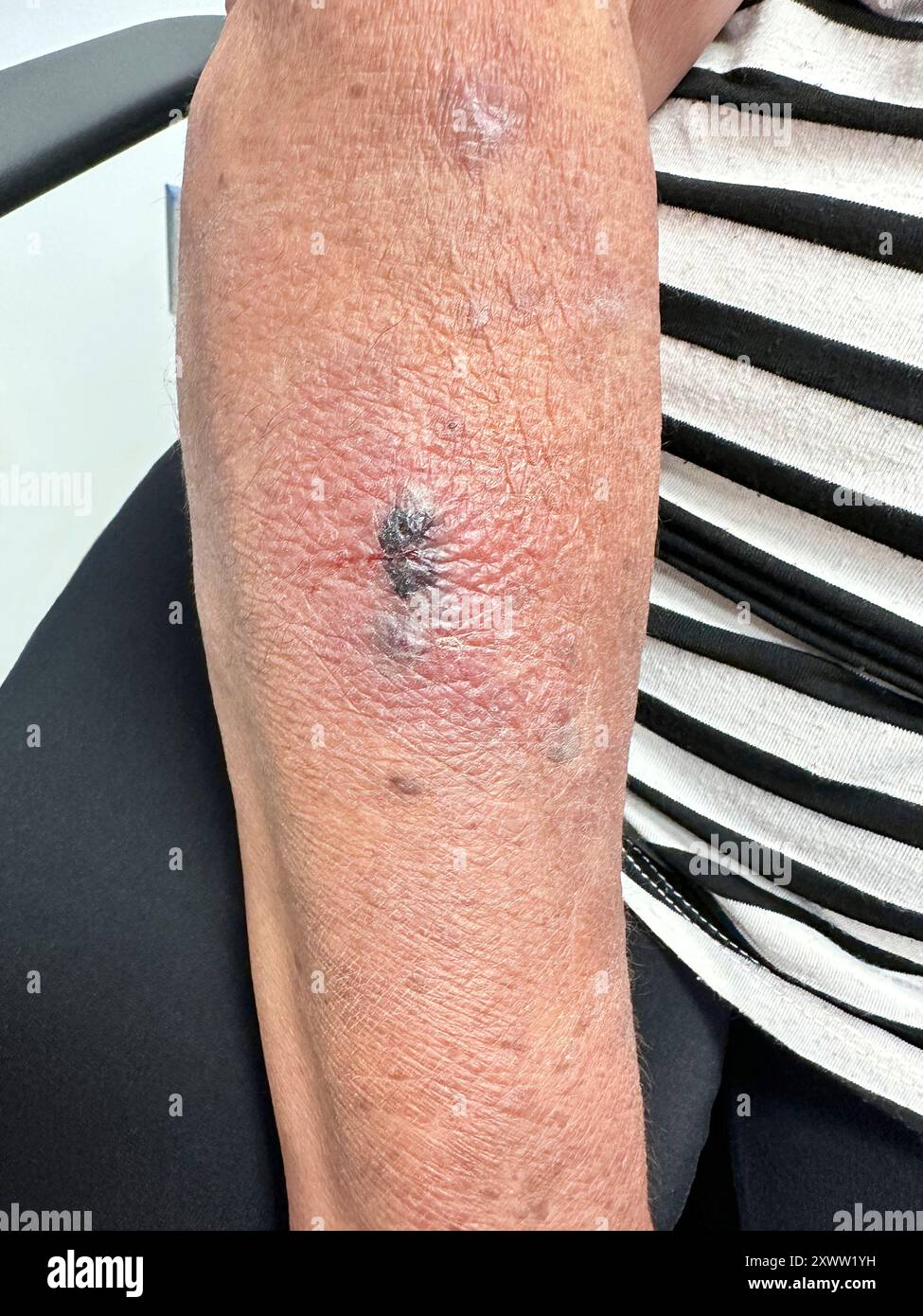 Telangiectasia macularis eruptiva perstans (TMEP) lesion on a Hispanic ...