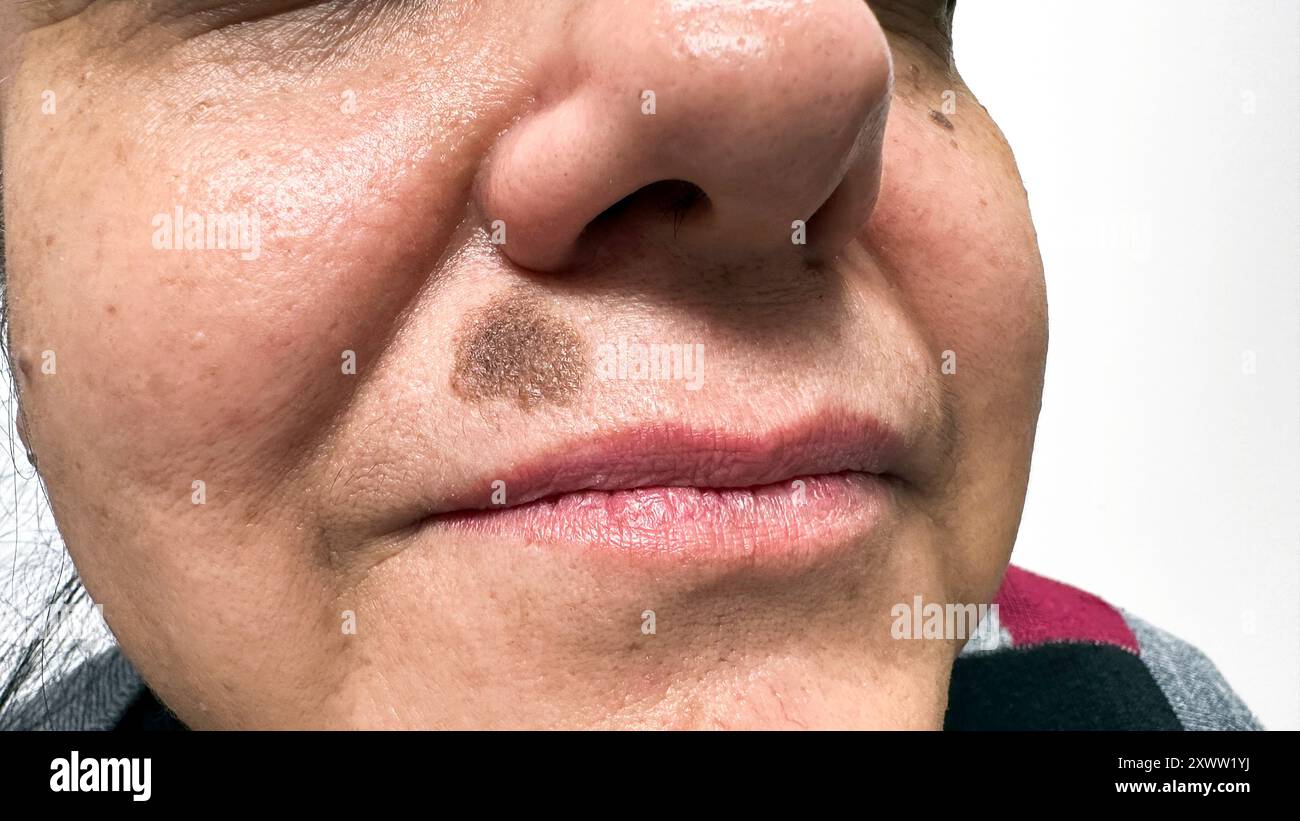 Seborrheic keratosis on a patient's upper lip. This skin growth, also ...