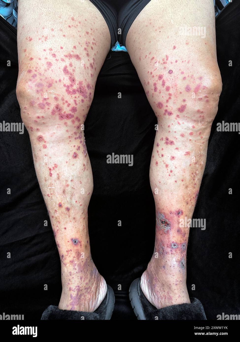 IgA (immunoglobulin A) vasculitis rash on the legs of a patient who has ...