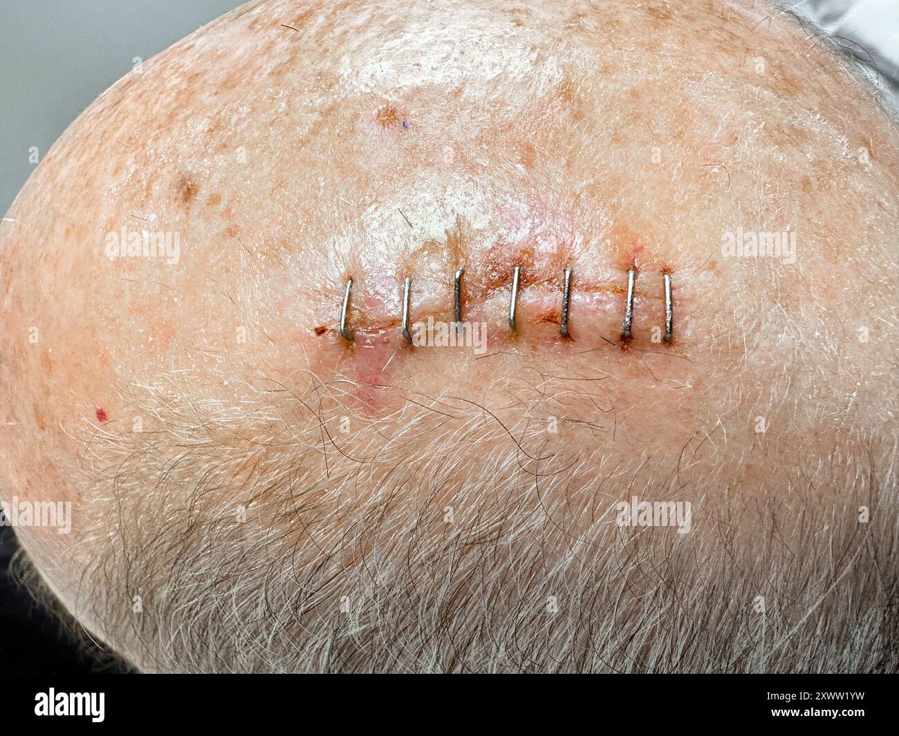 Stapled wound on a patient's scalp., one person, medicine, medical ...