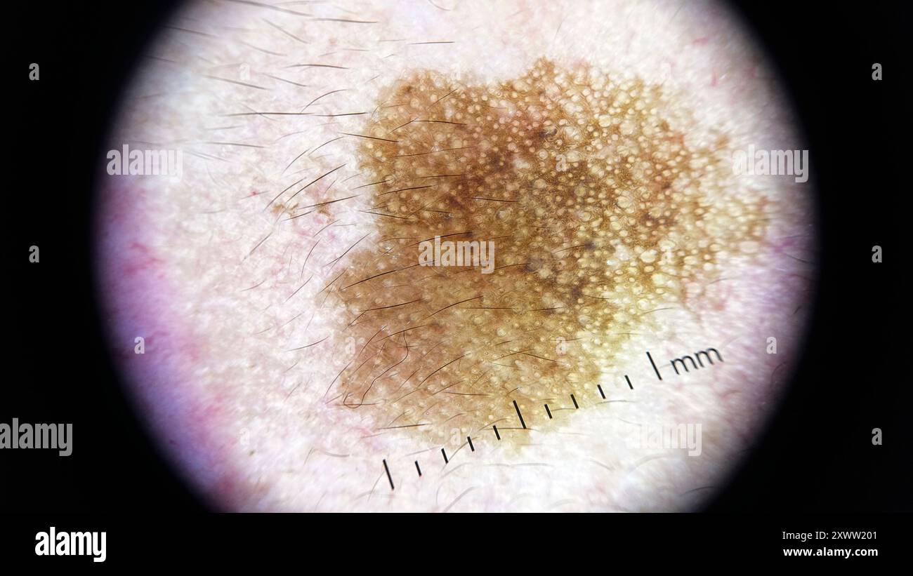 Dermatoscope image of a seborrheic keratosis on a patient's upper lip ...