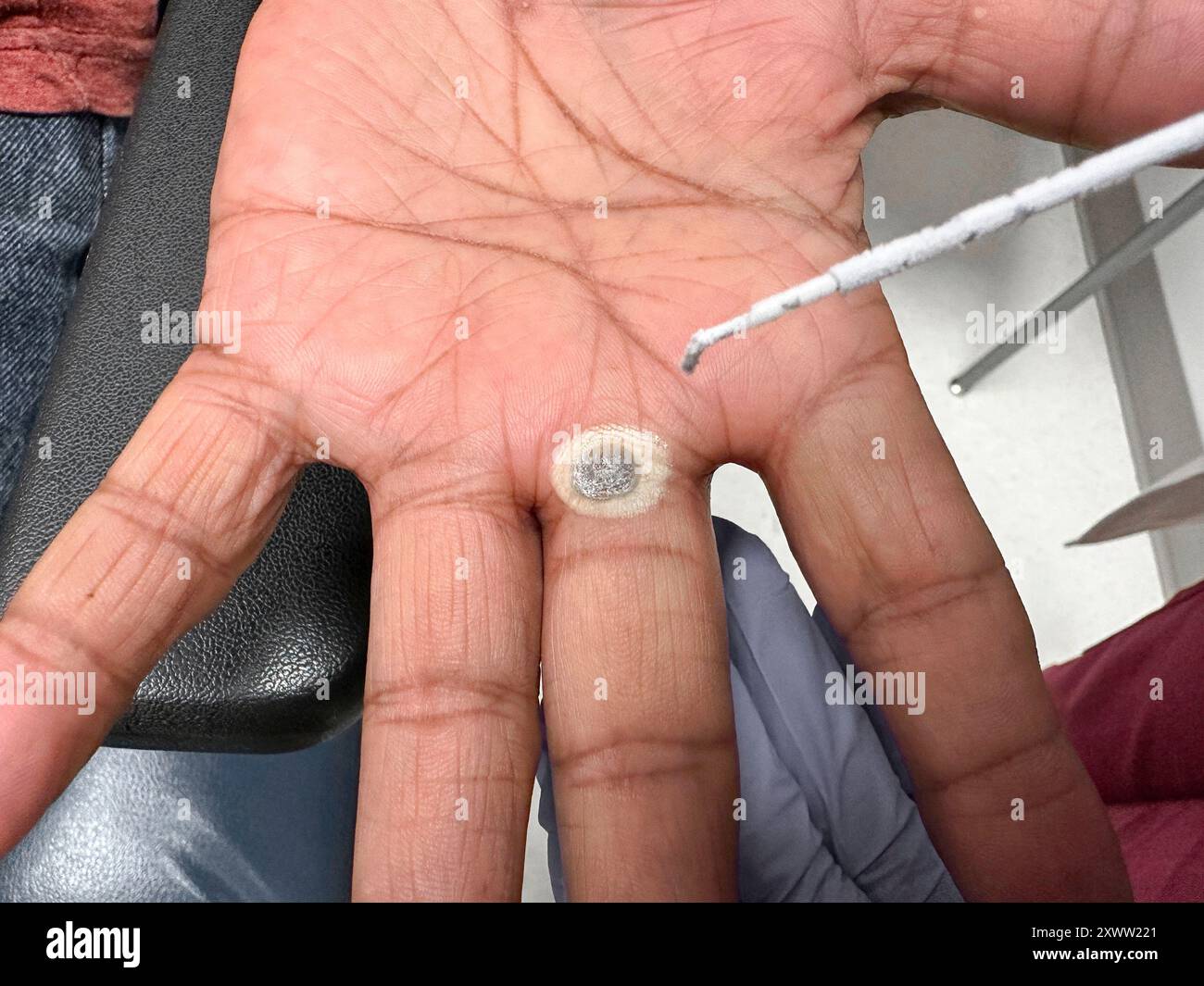 Cryotherapy to remove a wart on a patient's hand. Cryotherapy uses ...