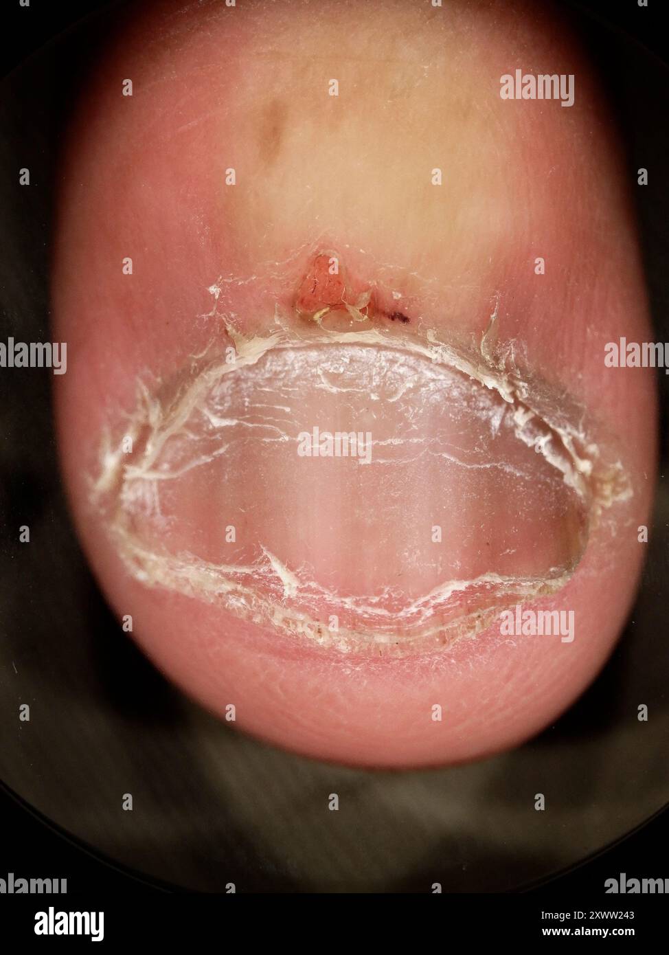 Dermatoscope image of the fingernail of a Hispanic male patient with ...