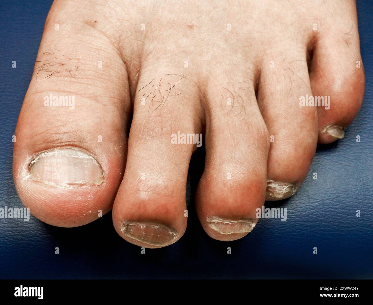 Toenails of a Hispanic male patient with melanonychia. Melanonychia is ...