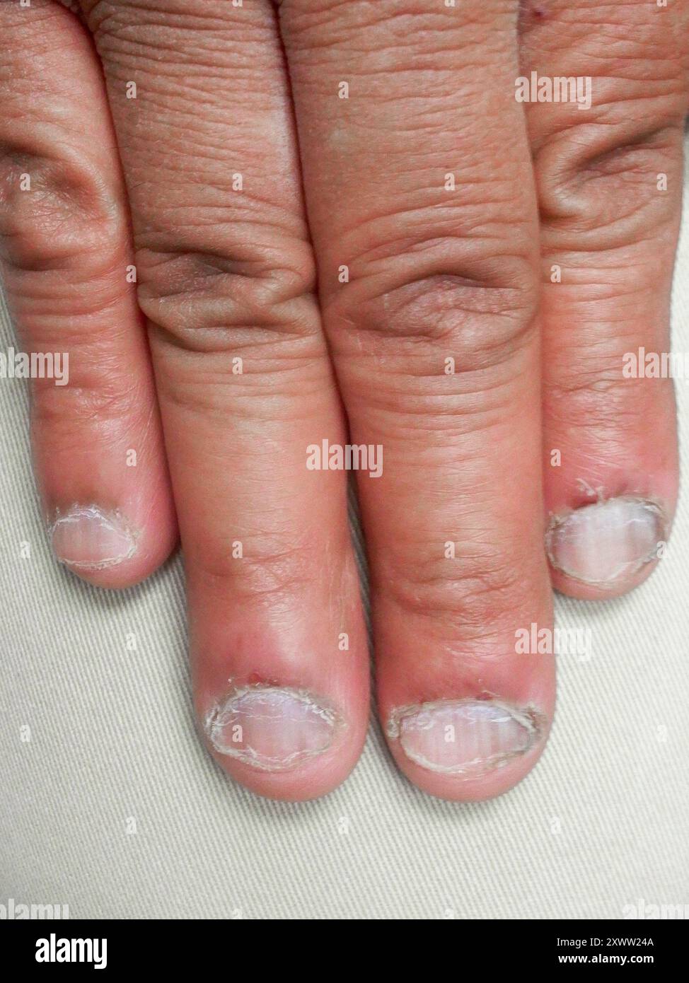 Fingernails of a Hispanic male patient with longitudinal (lengthwise ...
