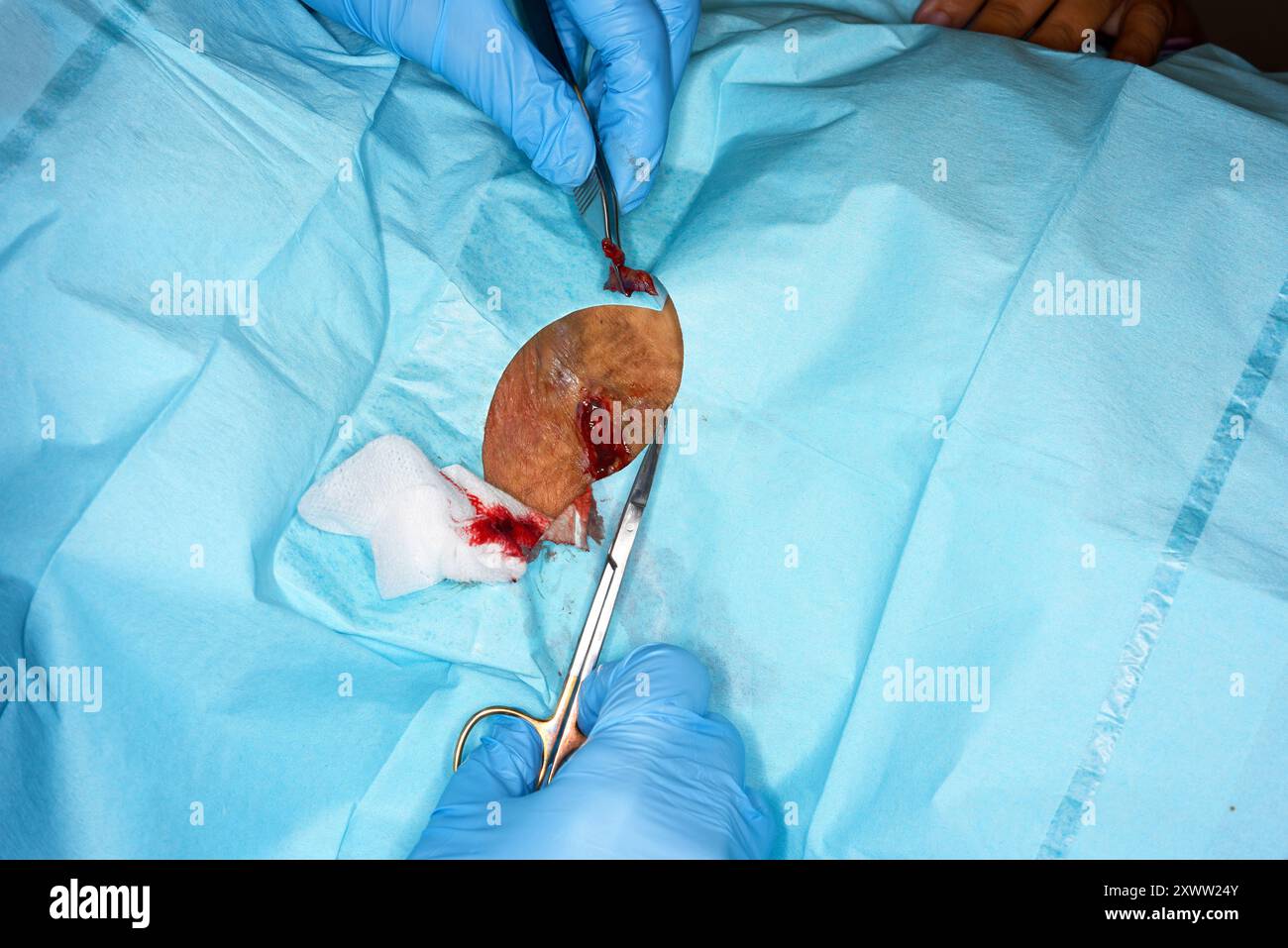 Hidradenitis suppurativa lesion in a 33 year old Hispanic female ...