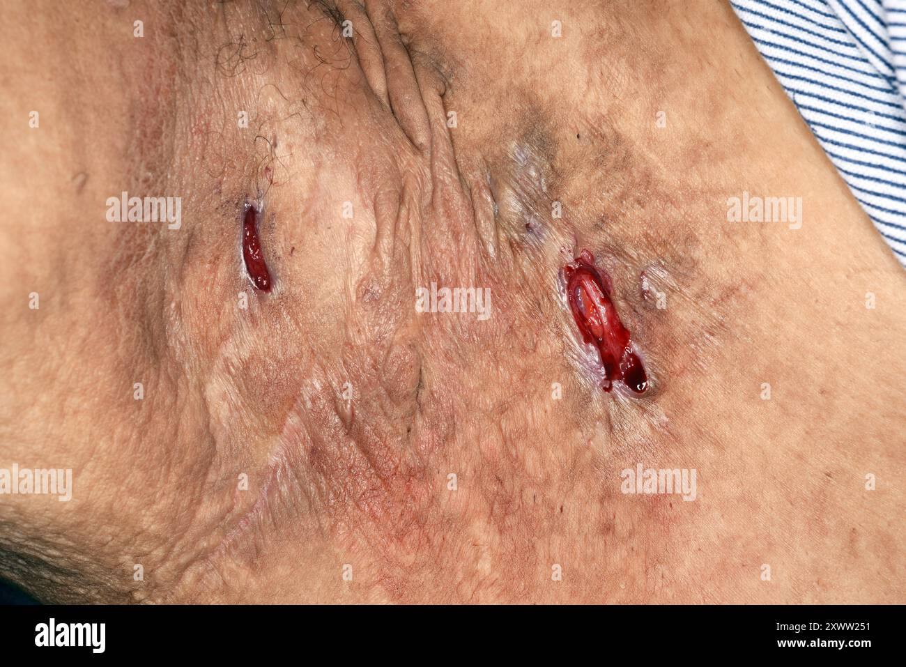 Hidradenitis suppurativa lesion in a 33 year old Hispanic female ...