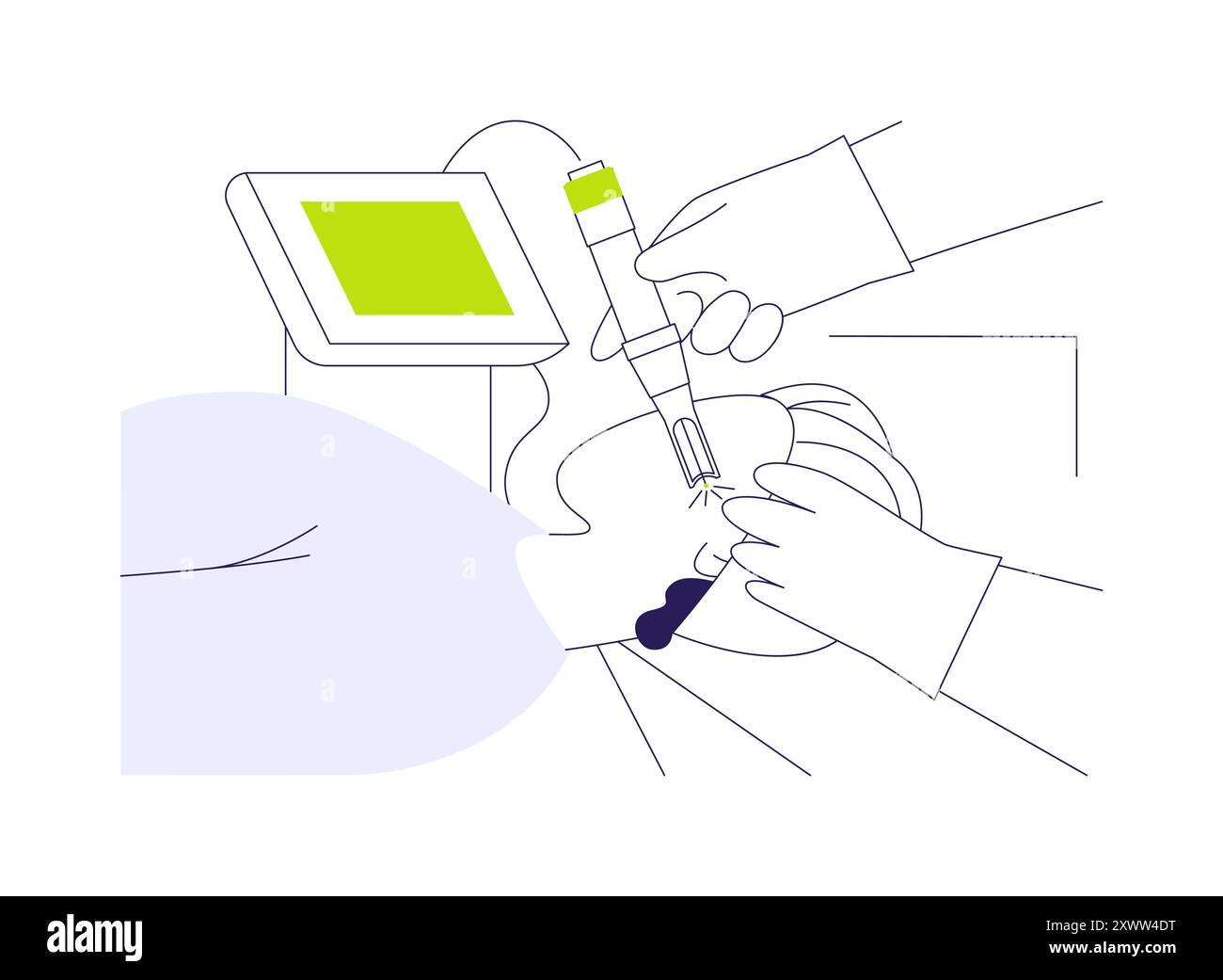 Medical laser application abstract concept vector illustration Stock ...