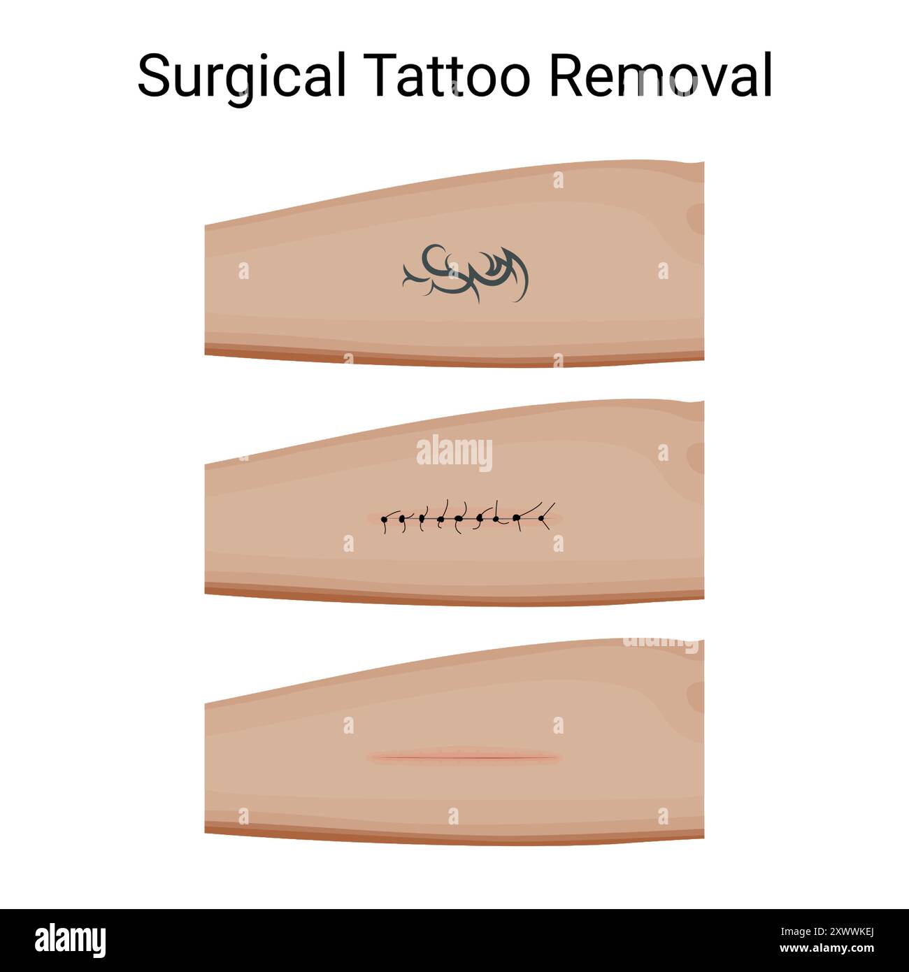 Steps of Surgical Tattoo Removal Process. Vector illustration design ...