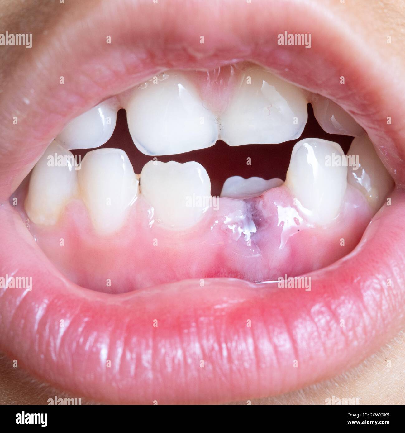 Child is showing the gap in their gum line after losing a baby tooth ...
