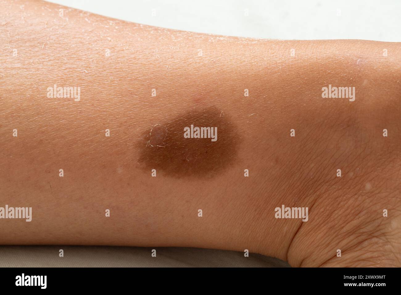 Large birthmark is showing on a person's leg, possibly requiring ...