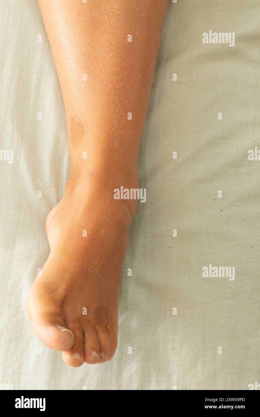 Woman is showing her legs with dry skin after sunbathing, needing ...