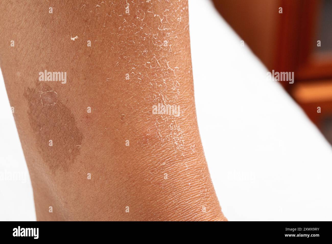 Leg suffering from dryness with white and brown spots on skin Stock ...