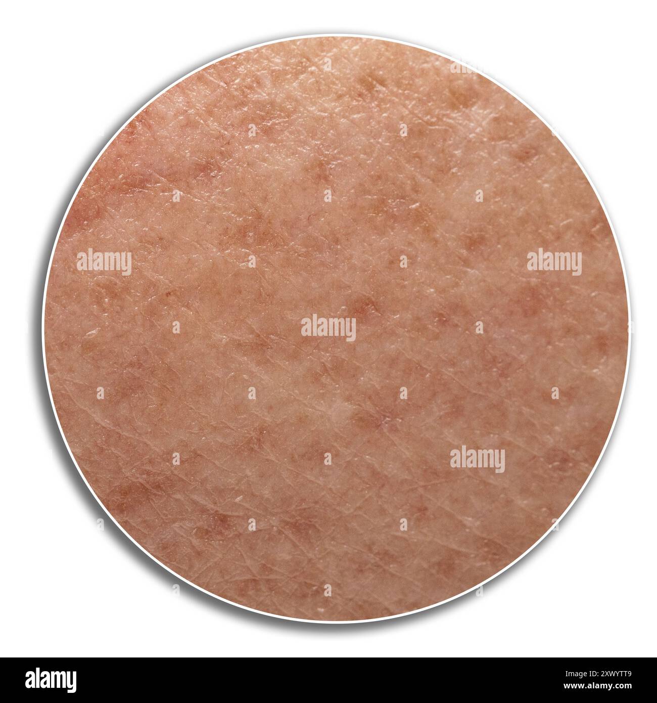 Skin closure that needs care following long exposure to uva uvb rays ...