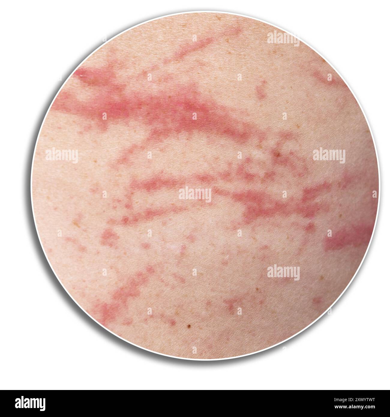 Magnification circle showing excoriations on the skin due to scratches ...