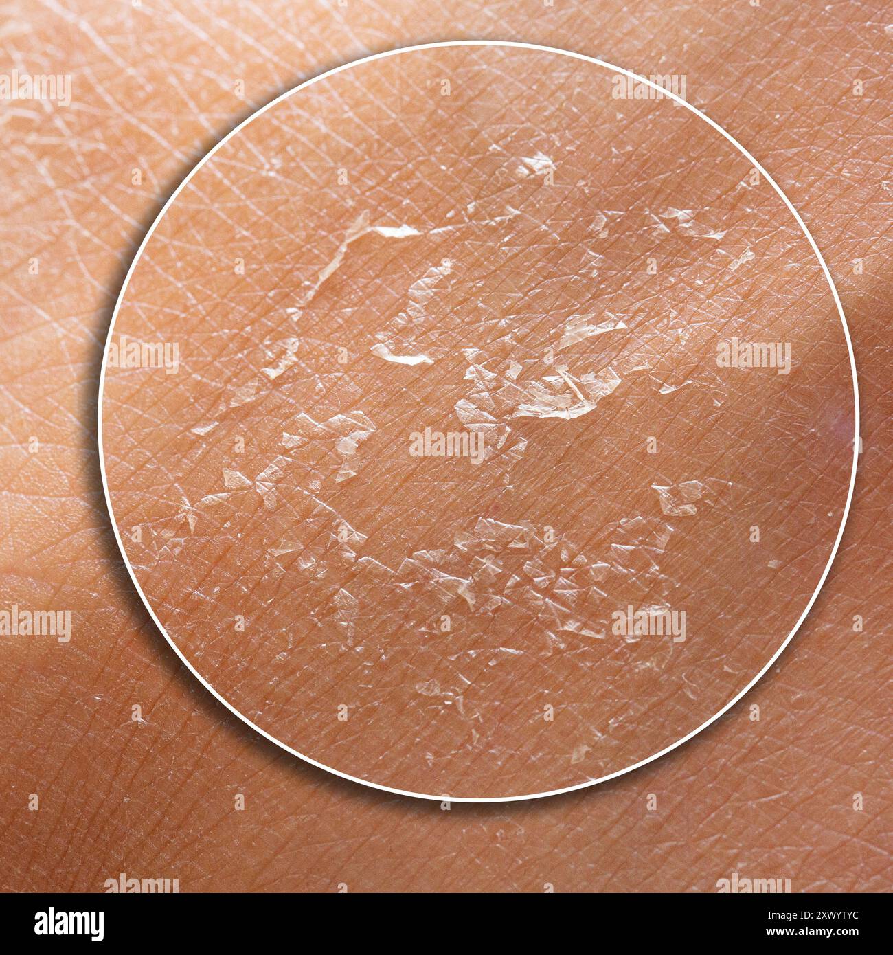 Macro shot of dry human skin flaking and peeling on the surface Stock ...