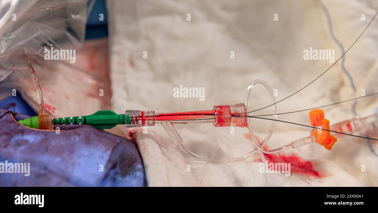 Heart stent placement process in operating room. Heart doctor inserting ...