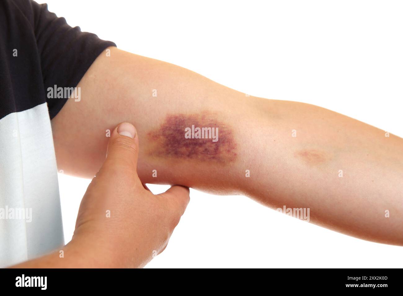 Woman with bruise on arm against white background, closeup Stock Photo ...