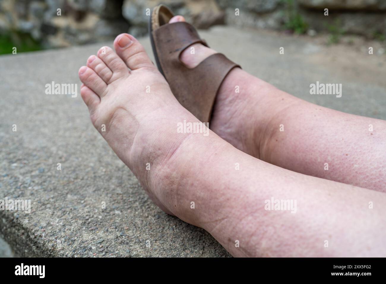 Oedema leg hi-res stock photography and images - Alamy