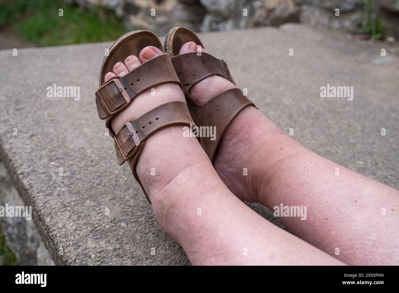 Swollen lower leg and foot showing symptoms of oedema, with stretched ...