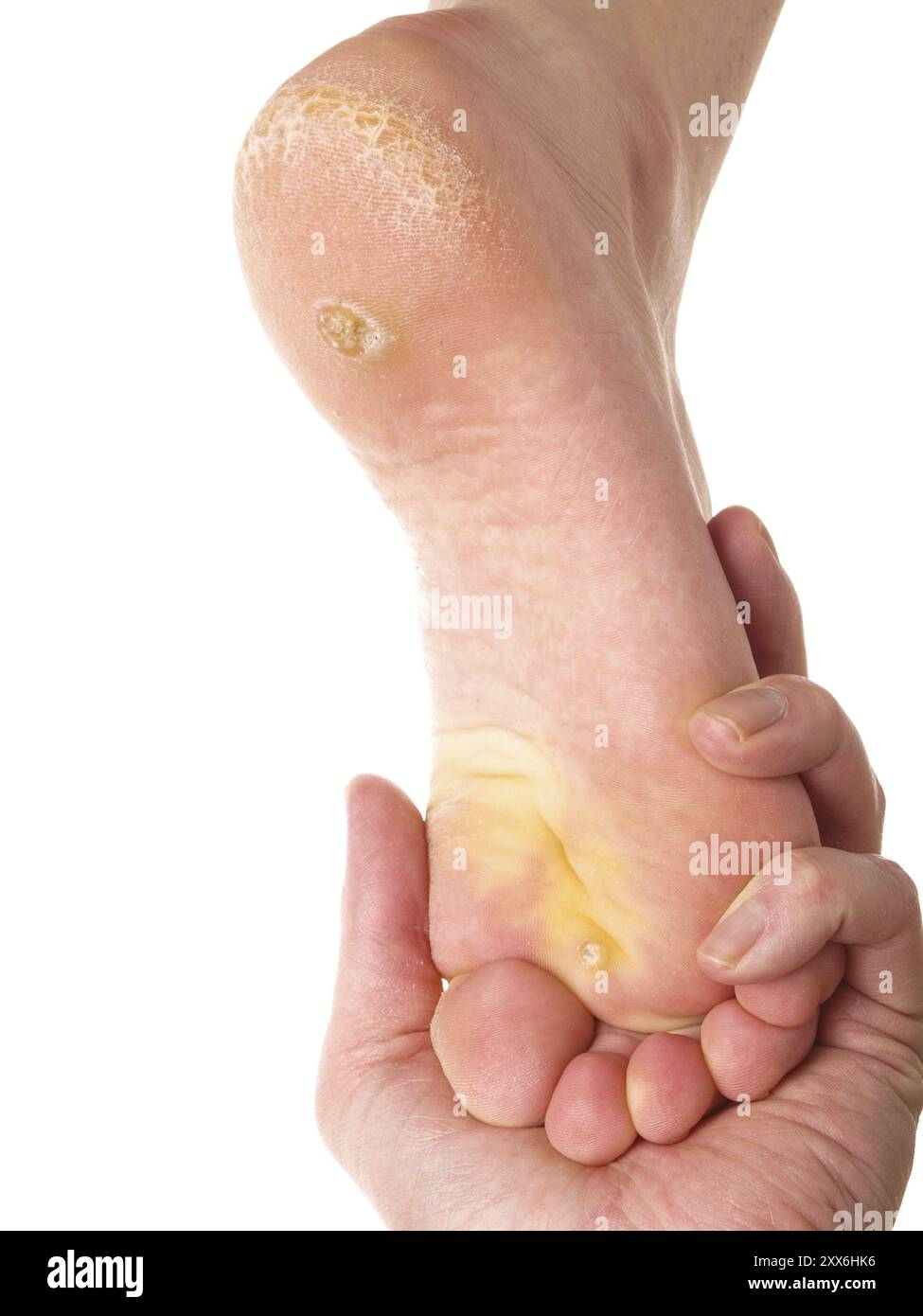 Dermatologist examining a foot for callus and dry skin, towards white ...