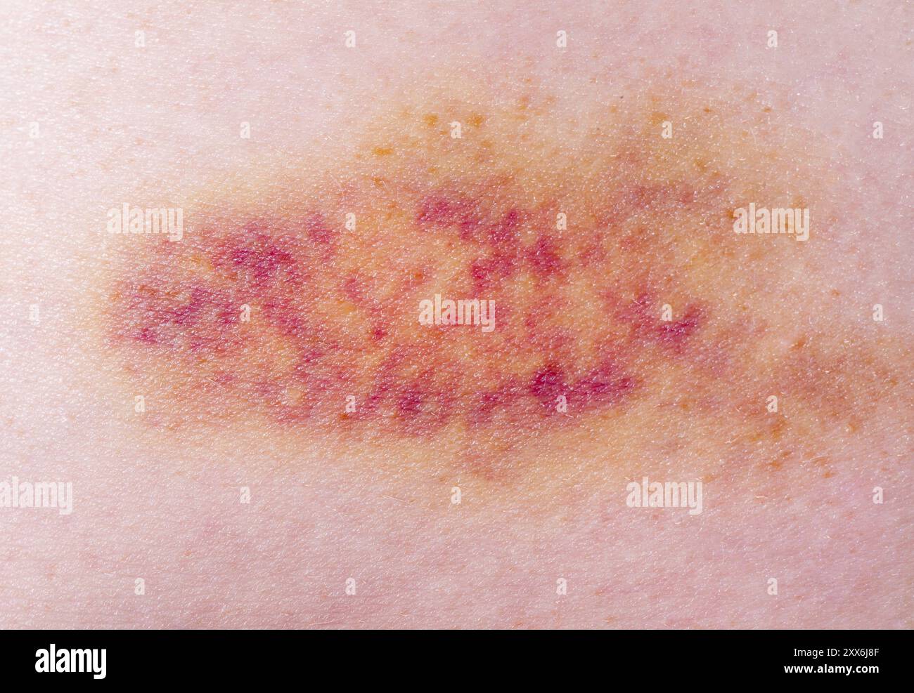 Closeup on a Bruise on wounded woman leg skin Stock Photo - Alamy