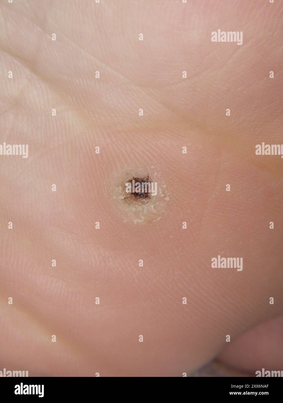 Black spotted callus under a human foot Stock Photo - Alamy