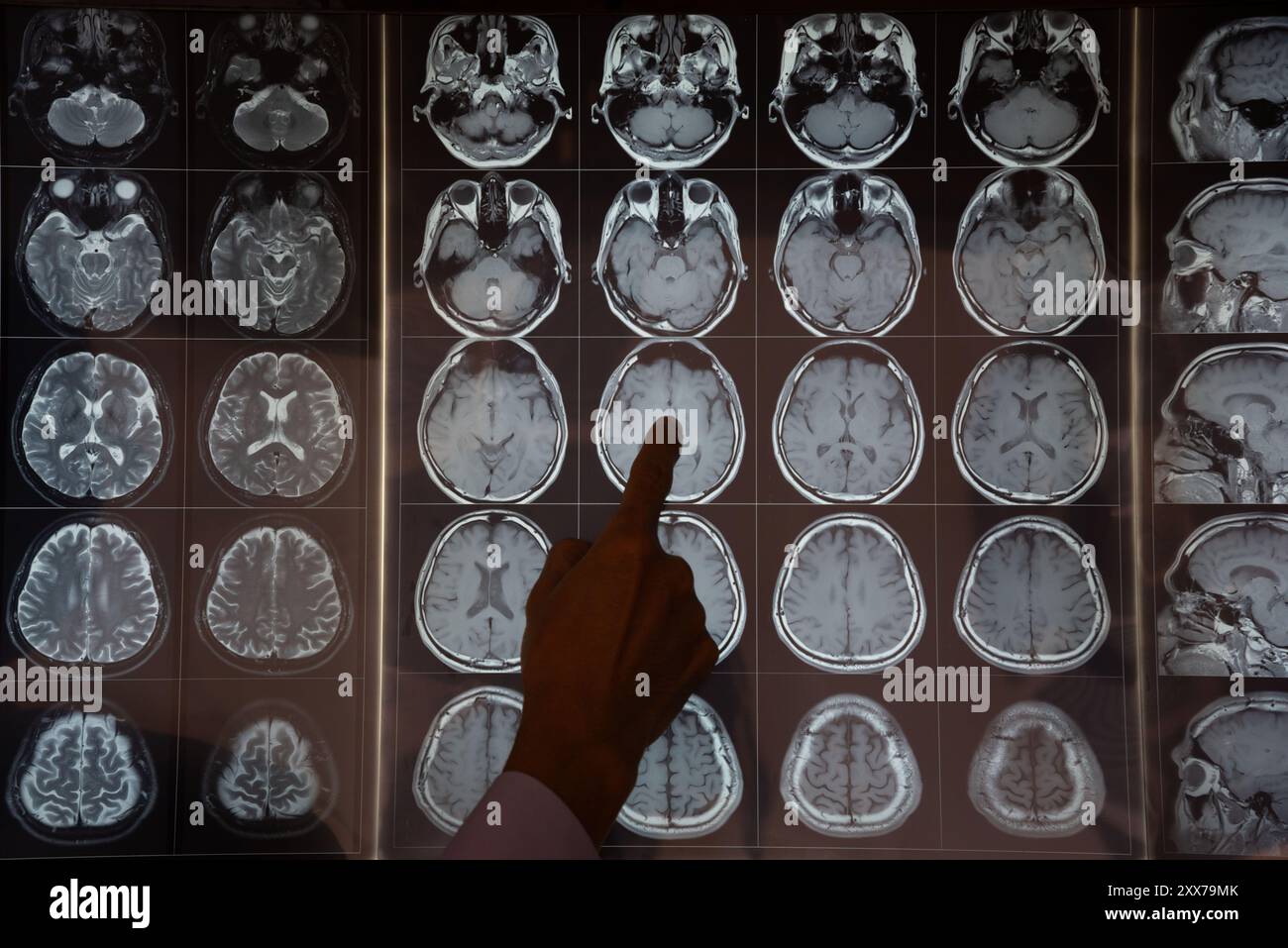 A healthcare professional examines multiple MRI brain scans displayed ...